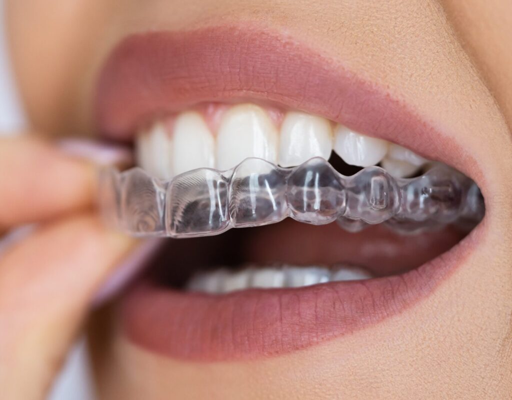 Clear Aligners And Invisalign - Exotic Smiles & Aesthetics