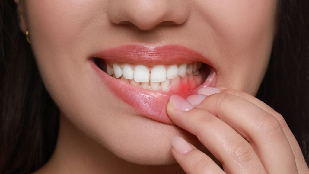 Gum Treatment - Exotic Smiles & Aesthetics